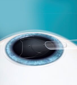 EVO ICL Vision Correction in Nashville | Vision for Life